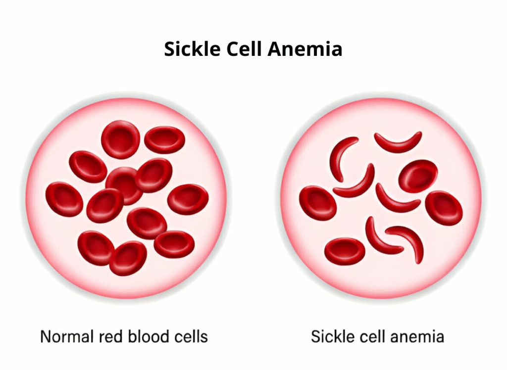 Sickle Cell Anemia treatment in Pune | Sickle Cell Anemia specialist in ...