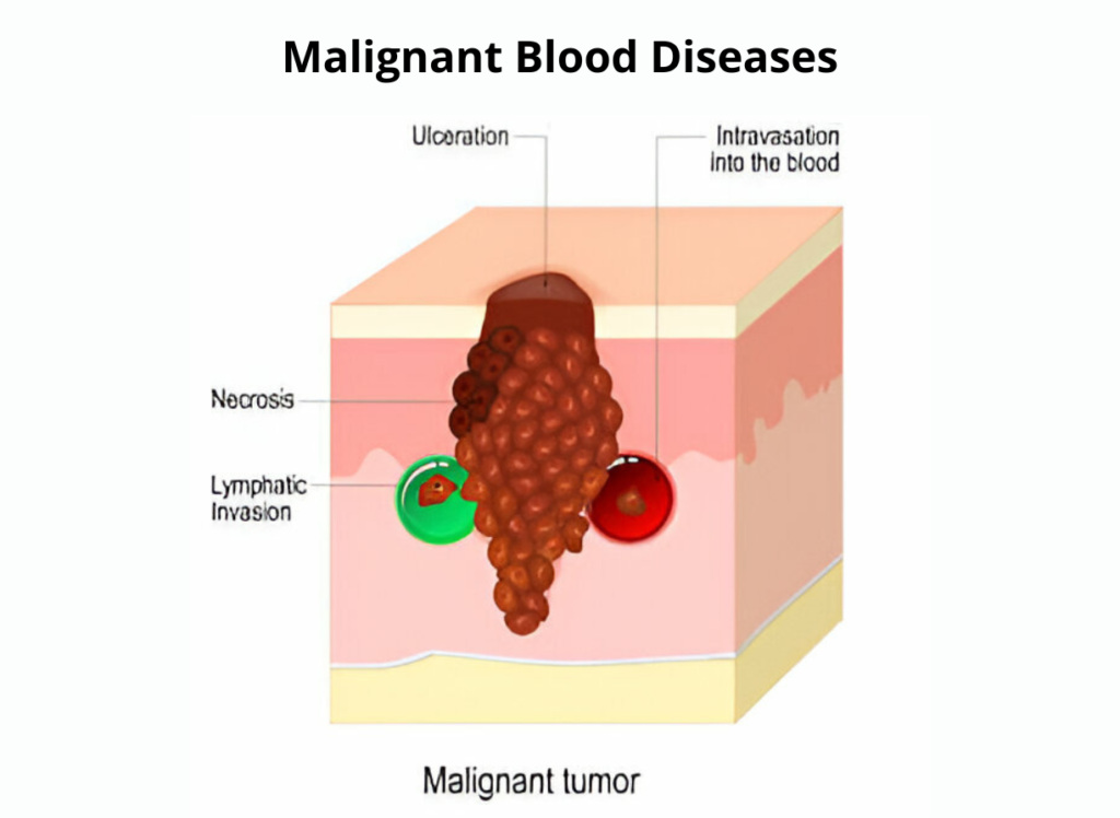 Malignant tumor treatment in Pune | Malignant tumor specialist in Pune ...