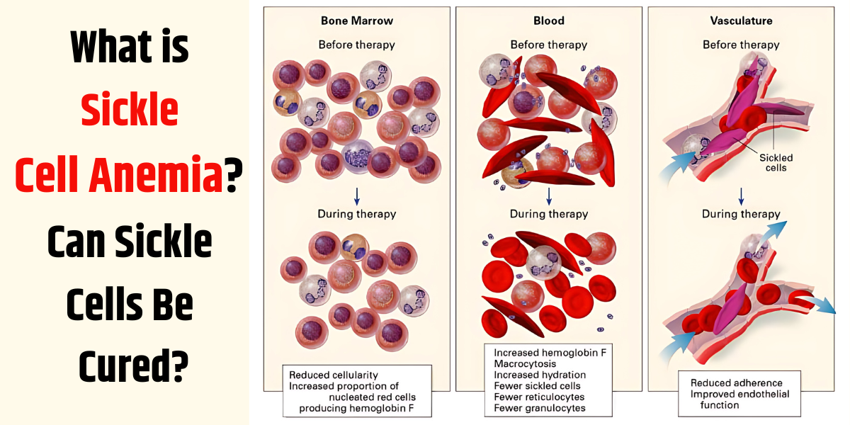 What is sickle cell anemia? Can sickle cells be cured?